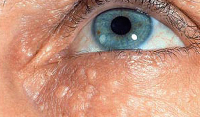 Warzen & Hautveränderungen - Hautarzt Wien - Dr. Barbara Franz