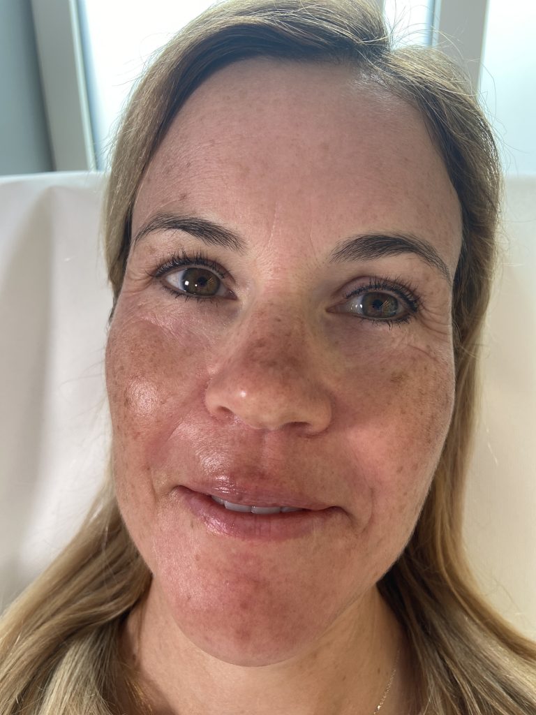 Pigmentflecken entfernen - Hautarzt Wien - Dr. Barbara Franz