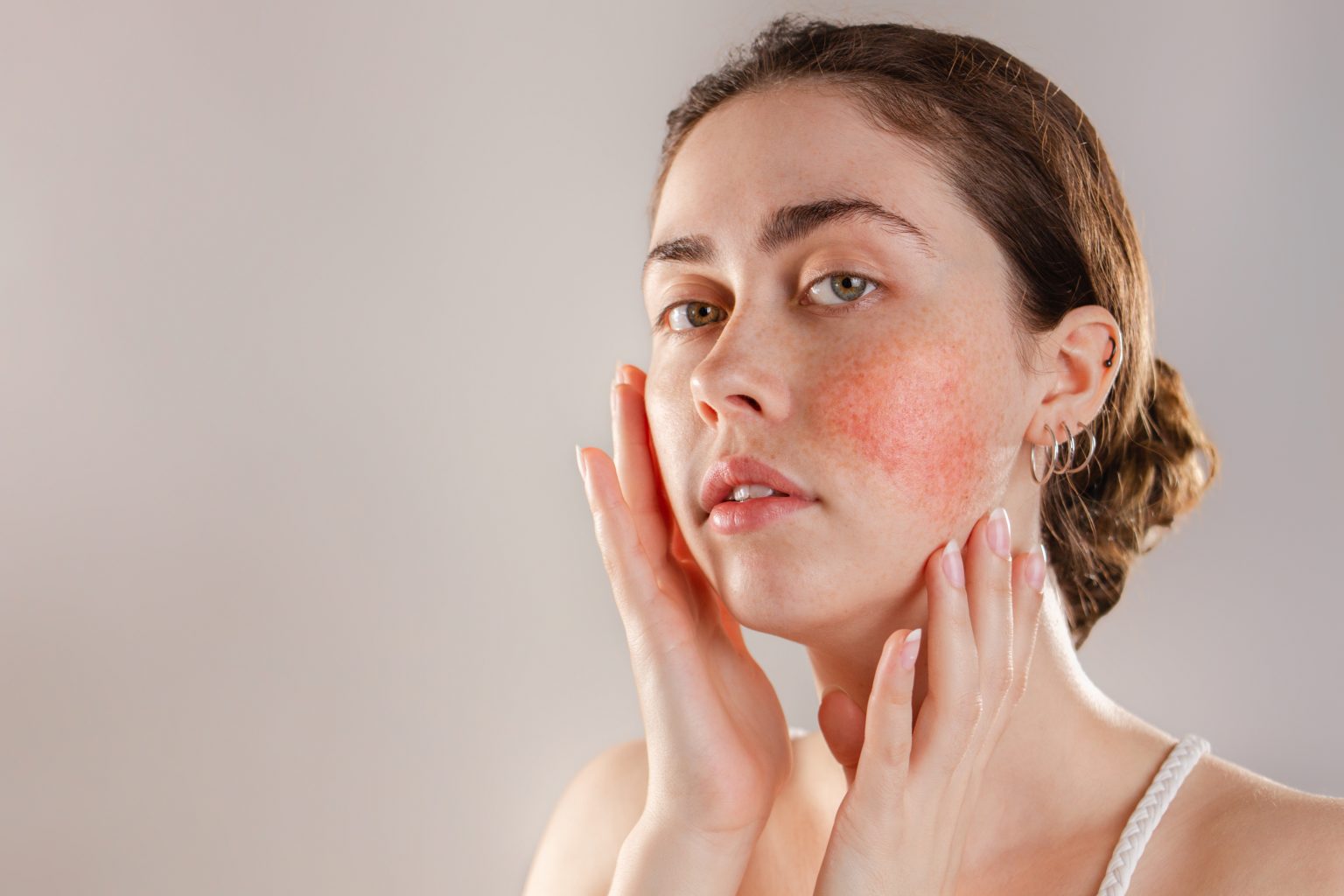 Couperose & Rosacea - Hautarzt Wien - Dr. Barbara Franz
