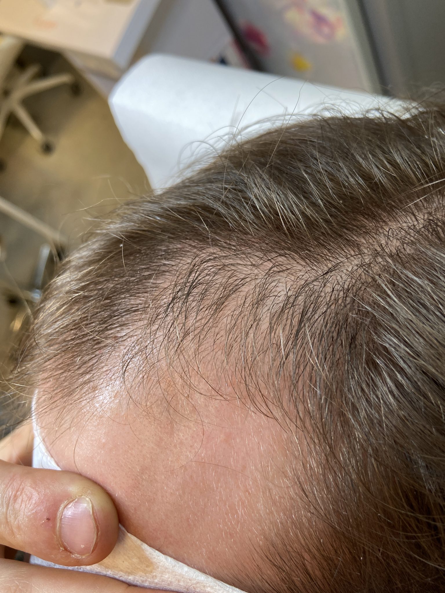 Eigenbluttherapie bei Haarausfall - Hautarzt Wien - Dr. Barbara Franz