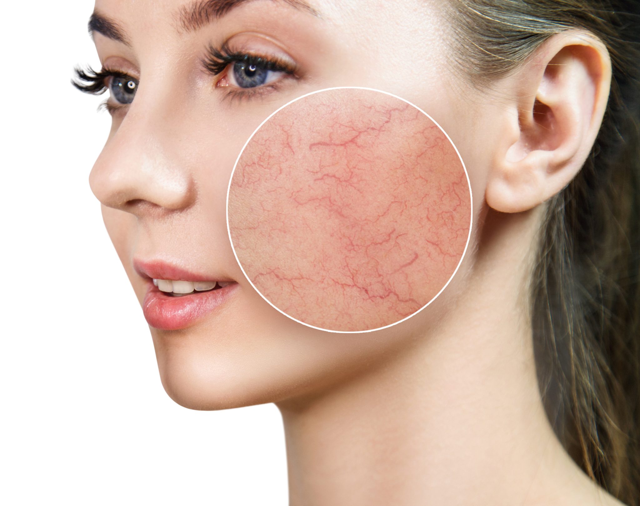 Rosacea Behandlung Wien | Hautarzt Wien | Dr. Barbara Franz
