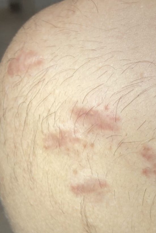 Narbenbehandlung - Hautarzt Wien - Dr. Barbara Franz