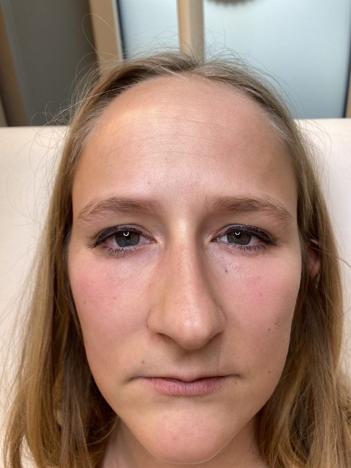 Augenringe entfernen - Hautarzt Wien - Dr. Barbara Franz