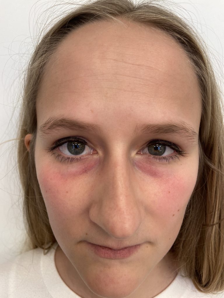 Augenringe entfernen - Hautarzt Wien - Dr. Barbara Franz