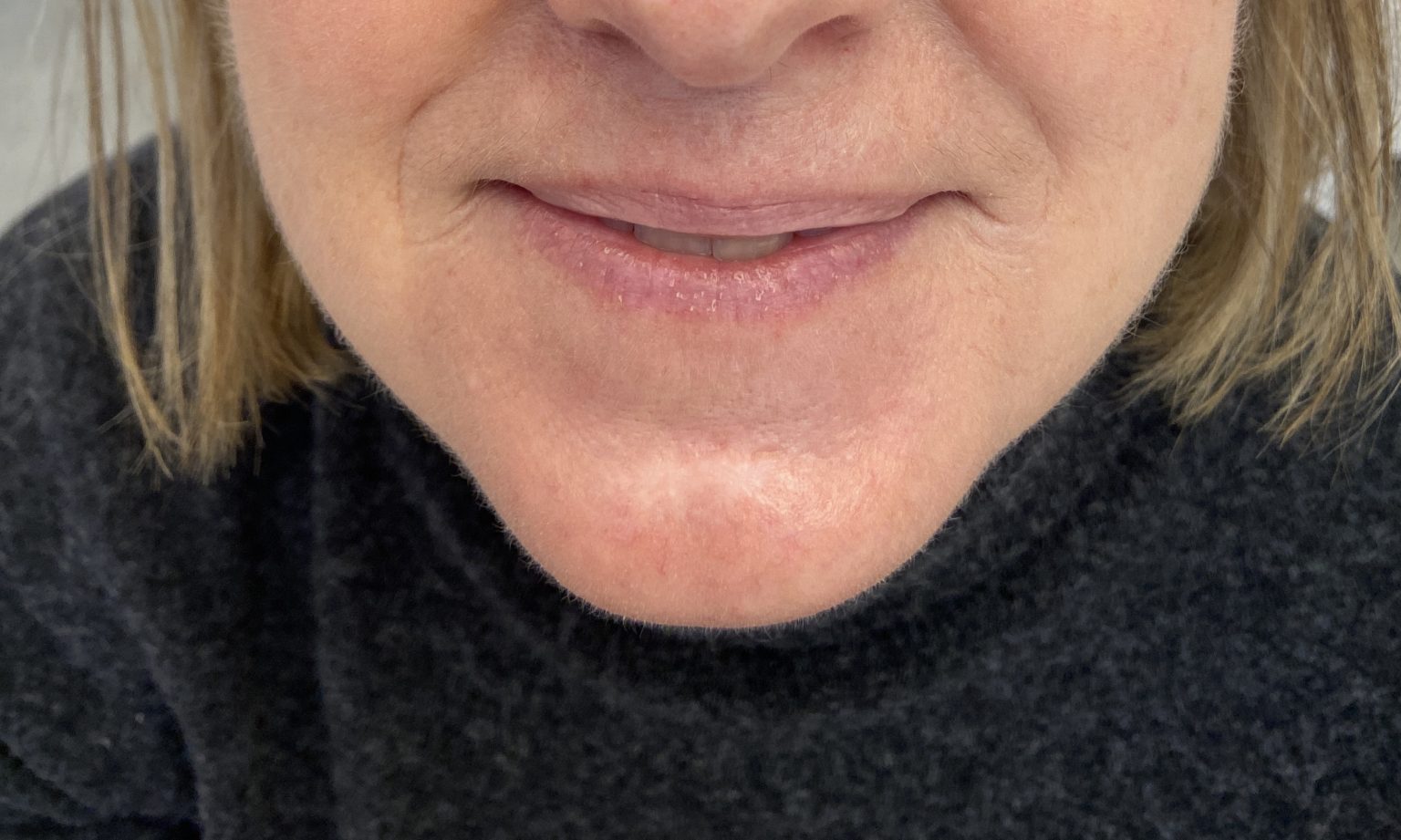 Faltenbehandlung mit Laser | Hautstraffung Wien | Dr. Franz