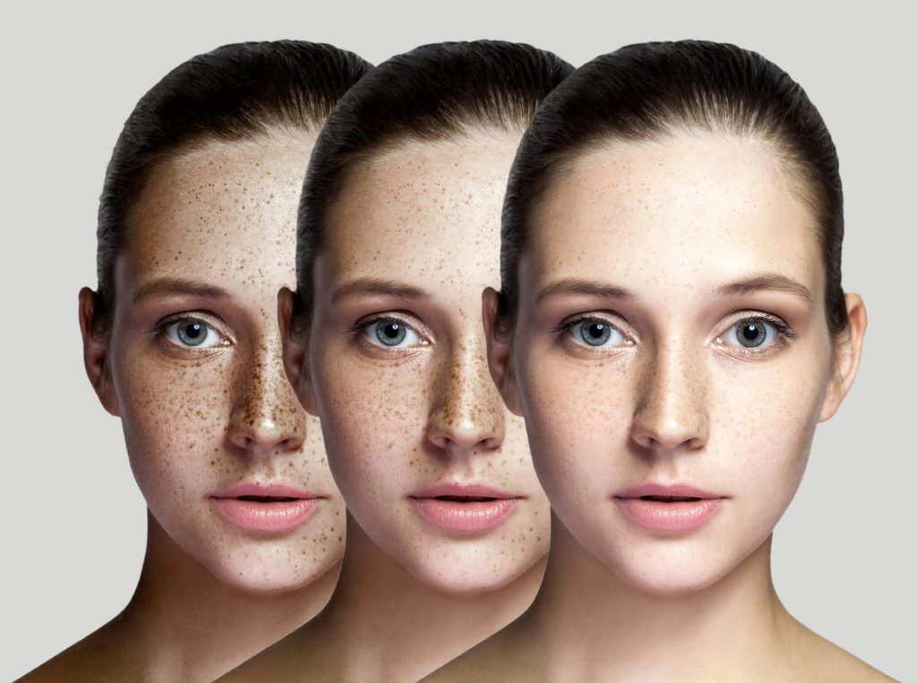 Pigment spots on neck & hands - Hautarzt Wien - Dr. Barbara Franz
