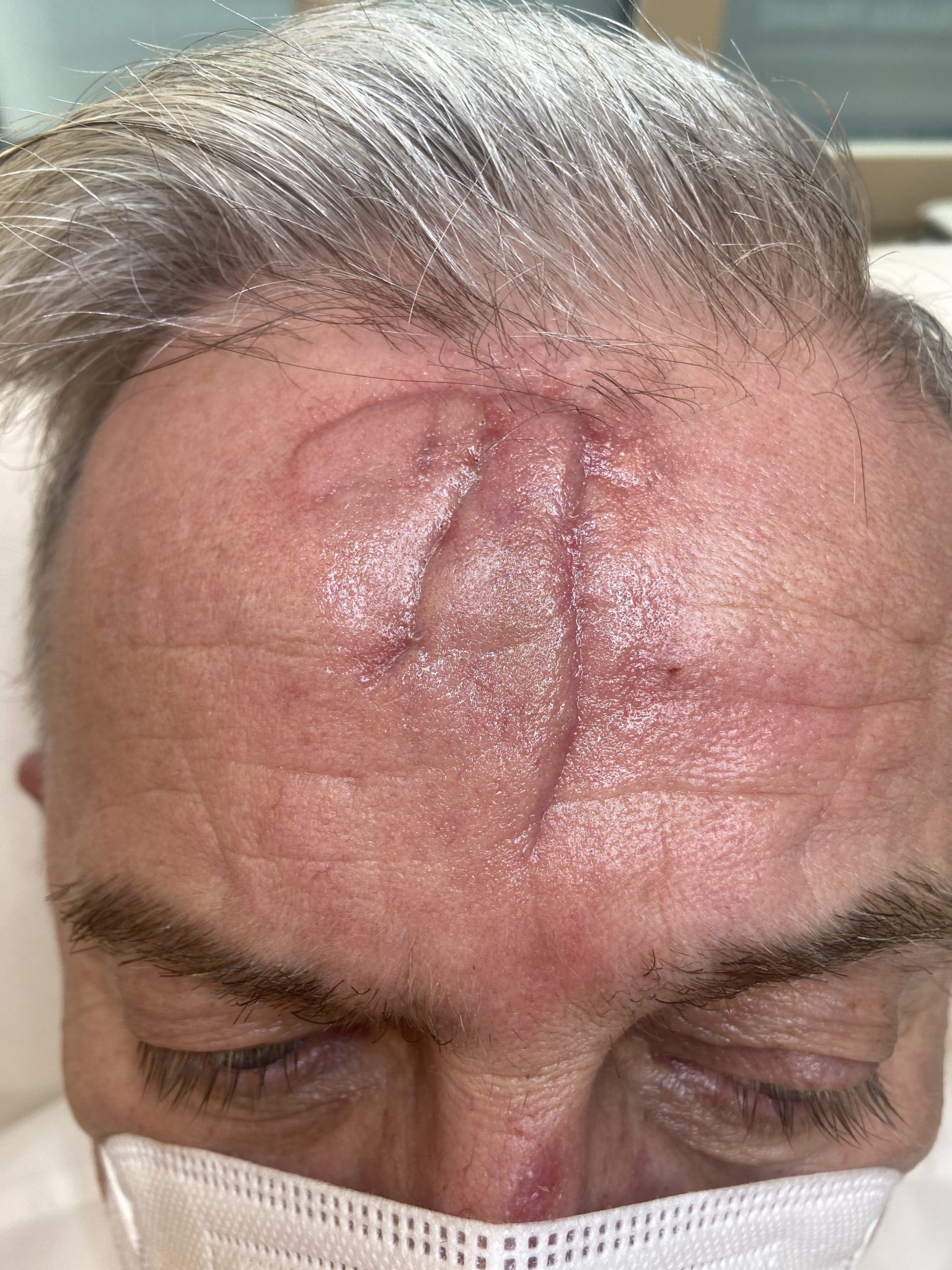 Narbenbehandlung - Hautarzt Wien - Dr. Barbara Franz