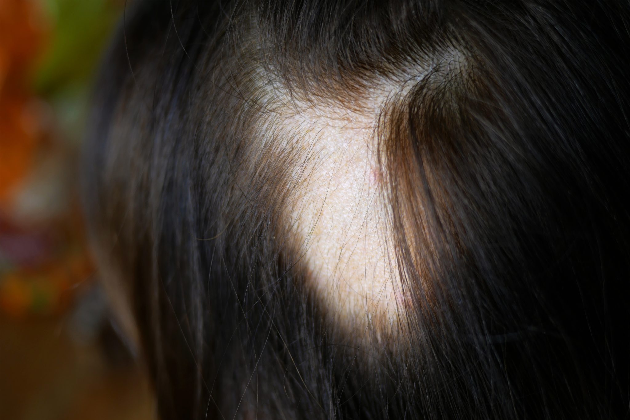 Kreisrunder Haarausfall - Alopecia Areata - Hautarzt Wien - Dr. Barbara ...
